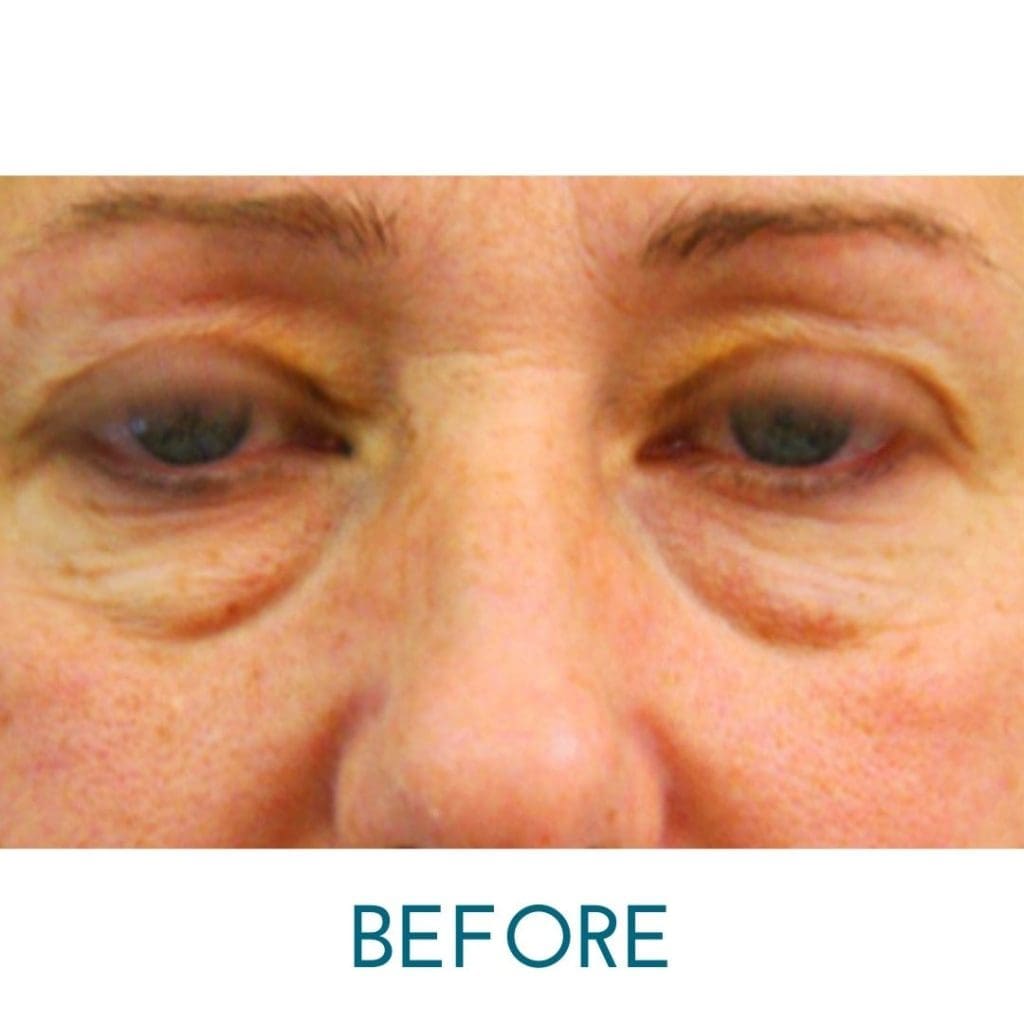 Endolift Treatment | Before & After | Perfect Skin Solutions