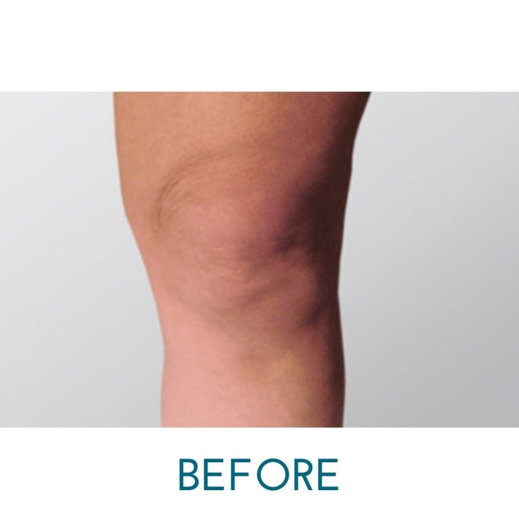 Endolift Treatment - Non-Surgical & Laser Facial Rejuvenation