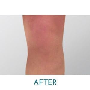 Endolift Treatment | Before & After | Perfect Skin Solutions