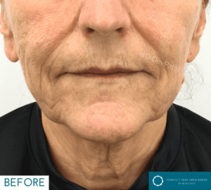 Endolift Treatment - Non-Surgical & Laser Facial Rejuvenation