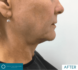 Endolift Treatment | Before & After | Perfect Skin Solutions