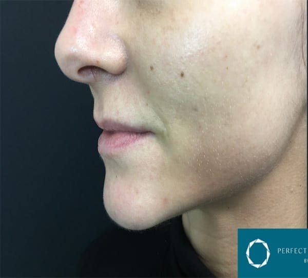 Temple/Forehead Fillers | Before & After | Perfect Skin Solutions