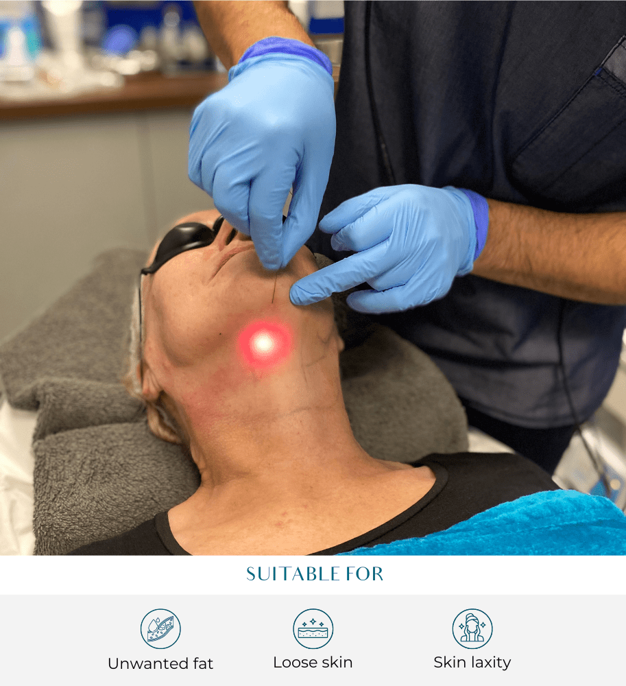 Endolift Treatment | Before & After | Perfect Skin Solutions