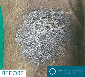 Exosomes Treatment | Exosome Therapy for Skin Rejuvenation | Perfect ...