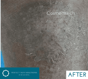 Exosomes Treatment | Exosome Therapy for Skin Rejuvenation | Perfect ...