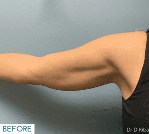 EvolveX Body Contouring - As Seen On The Telegraph!