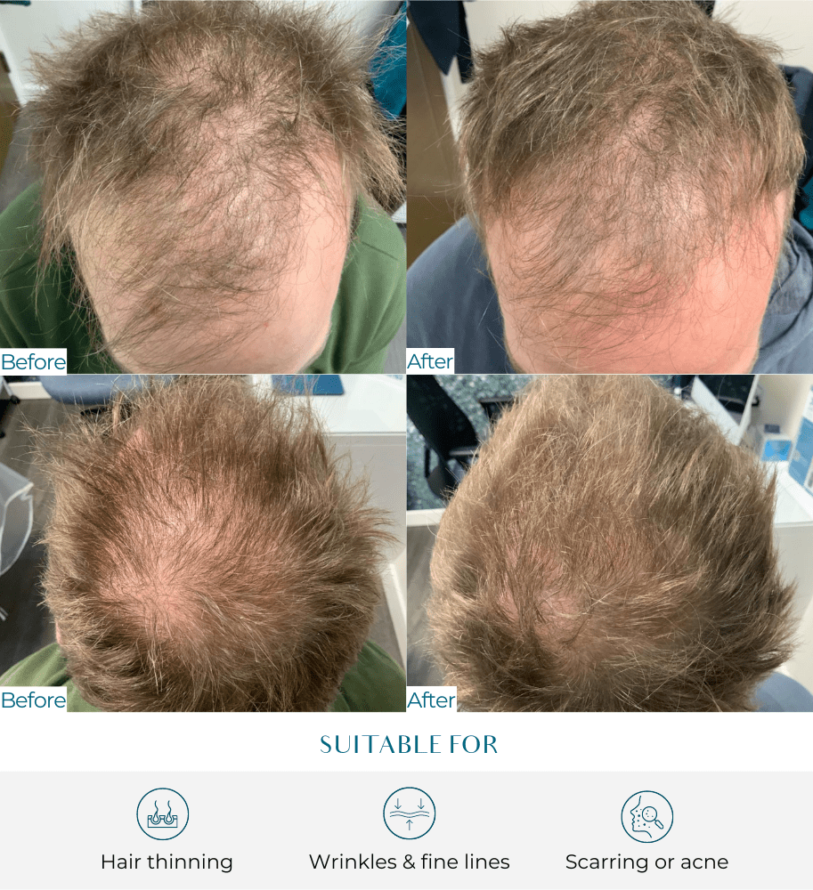 Exosomes Treatment | Exosome Therapy for Skin Rejuvenation | Perfect ...