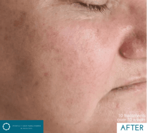 Dermalux Tri-Wave MD LED Phototherapy Treatment | Perfect Skin Solutions