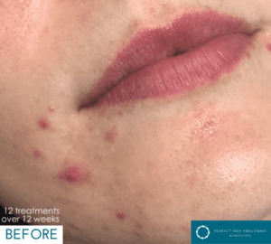 Dermalux Tri-Wave MD LED Phototherapy Treatment | Perfect Skin Solutions