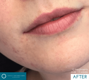 Dermalux Tri-Wave MD LED Phototherapy Treatment | Perfect Skin Solutions