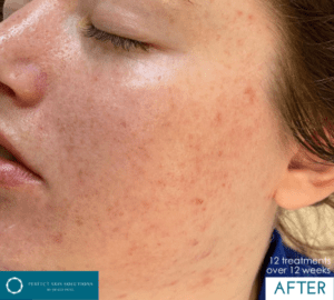 Dermalux Tri-Wave MD LED Phototherapy Treatment | Perfect Skin Solutions