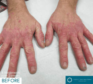 Dermalux Tri-Wave MD LED Phototherapy Treatment | Perfect Skin Solutions