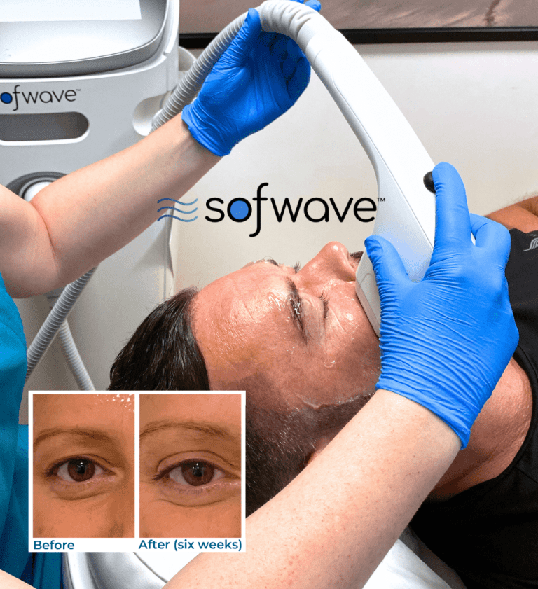 Sofwave Brow/Neck/FaceLift | Before & After Photos