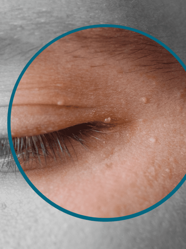 Cyst Removal Treatment | Get Rid of Unwanted Skin Cysts | Perfect Skin ...