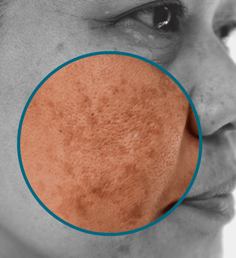 Melasma - Perfect Skin Solutions