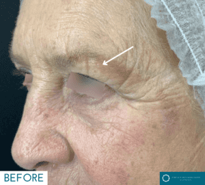 NeoGen PSR | Before & After Photos | Perfect Skin Solutions