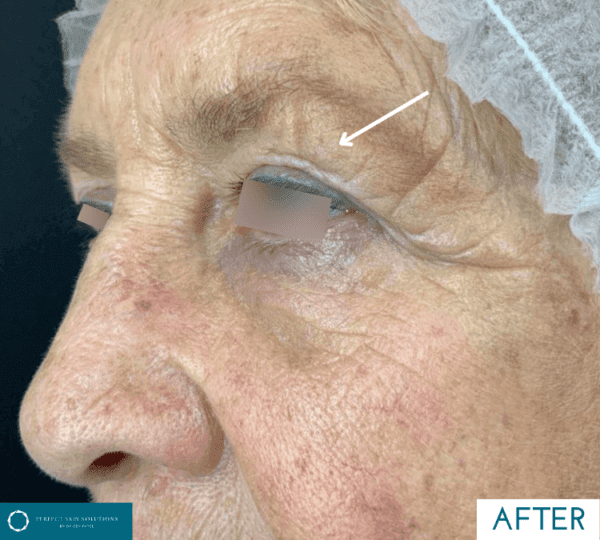 NeoGen PSR Treatments at Perfect Skin Solutions