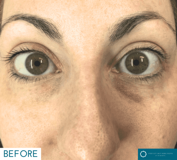 NeoGen PSR Treatments at Perfect Skin Solutions