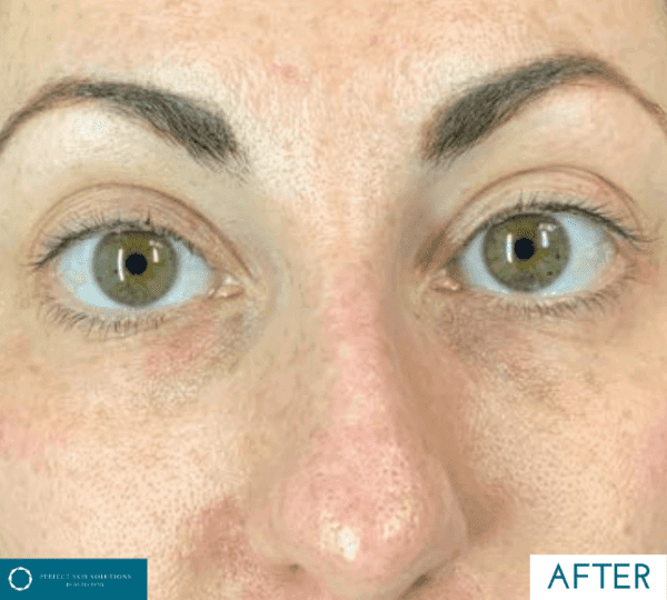 NeoGen PSR Treatments at Perfect Skin Solutions