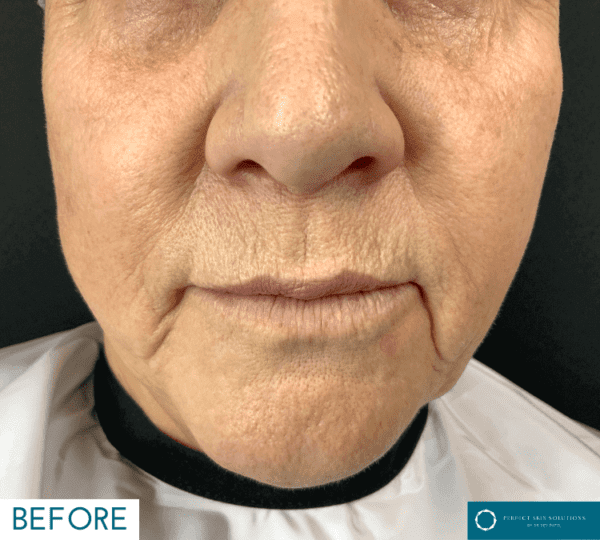 NeoGen PSR Treatments at Perfect Skin Solutions