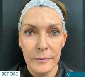 Sofwave Brow/Neck/FaceLift | Before & After Photos