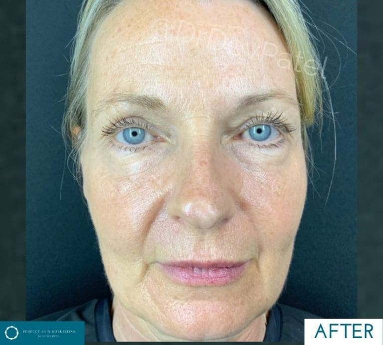 Sofwave Brow/Neck/FaceLift | Before & After Photos