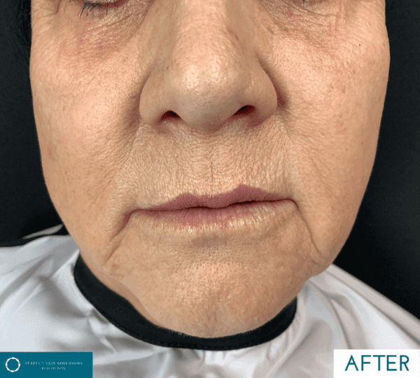 NeoGen PSR | Before & After Photos | Perfect Skin Solutions