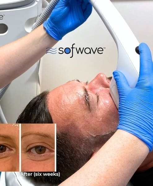 NeoGen PSR | Before & After Photos | Perfect Skin Solutions