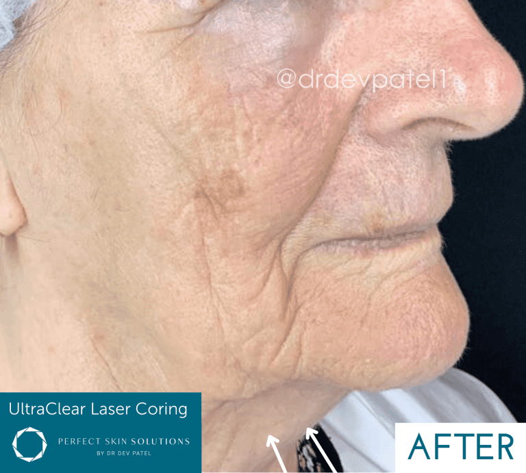 UltraClear From £450: Cold Fibre Laser Technology at Perfect Skin Solutions