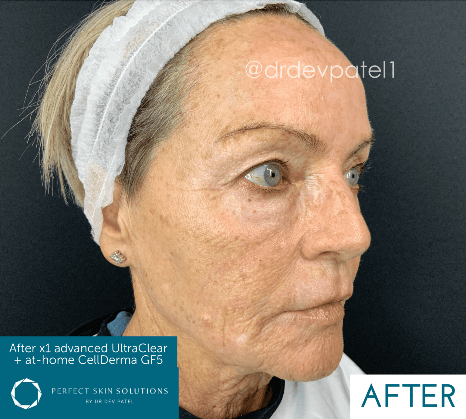 UltraClear From £450: Cold Fibre Laser Technology at Perfect Skin Solutions