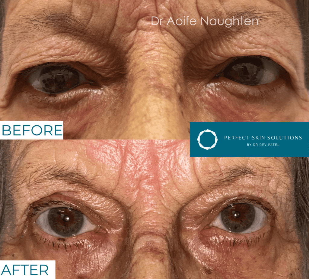 Eye Surgery - Perfect Skin Solutions