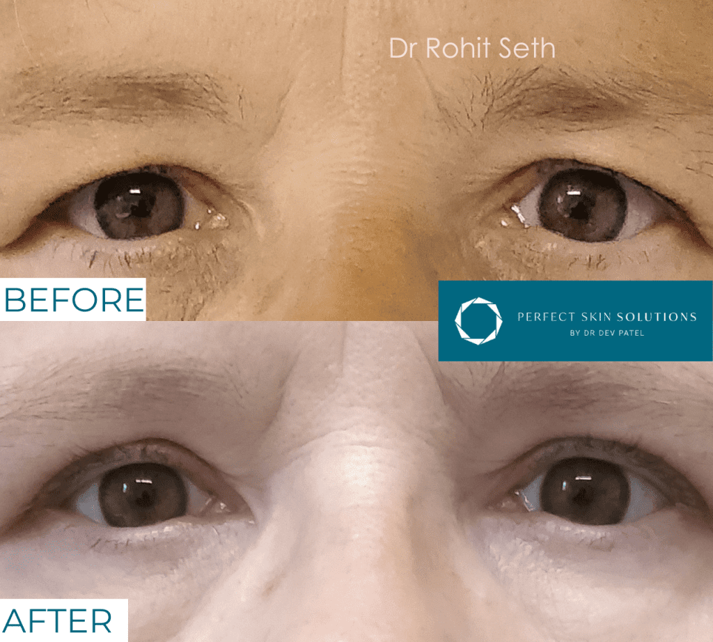 Eye Surgery - Perfect Skin Solutions