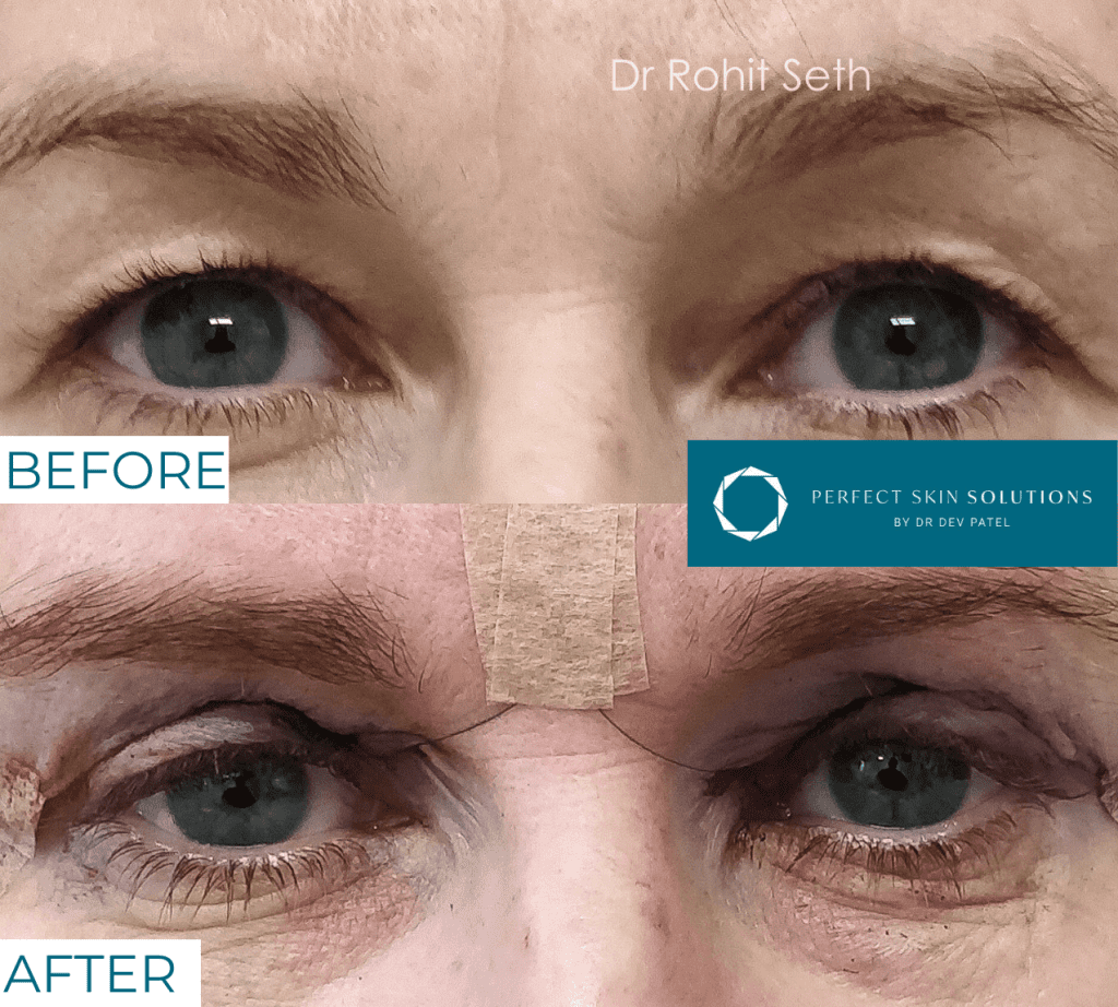Eye Surgery - Perfect Skin Solutions